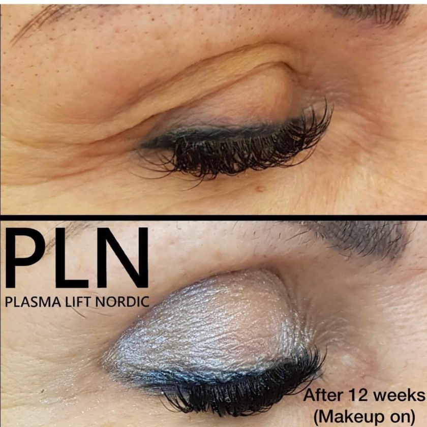 Plasma Lift Nordic | Gedin Studio